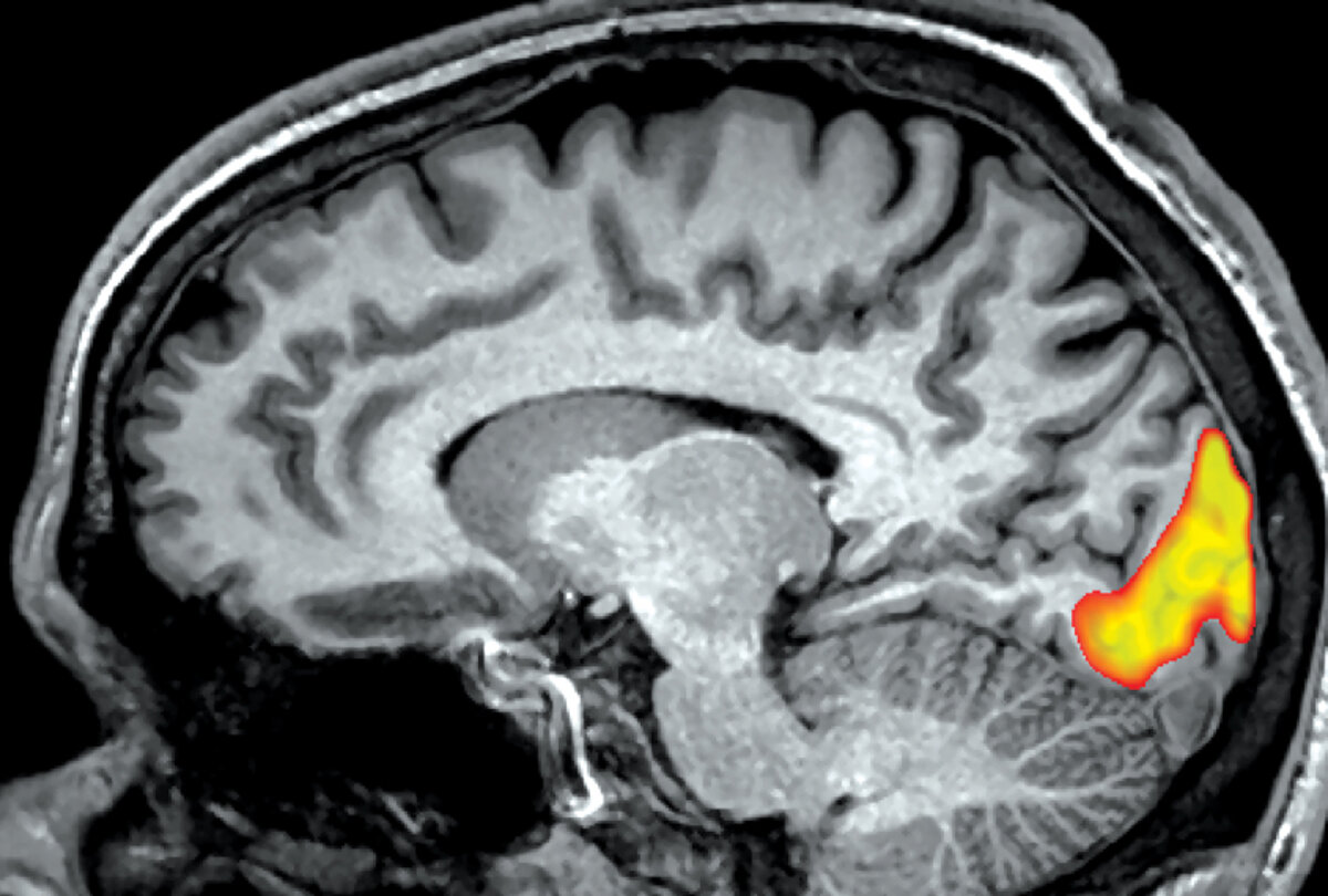 Autisme : maillons faibles dans les régions visuelles et sensorielles ...