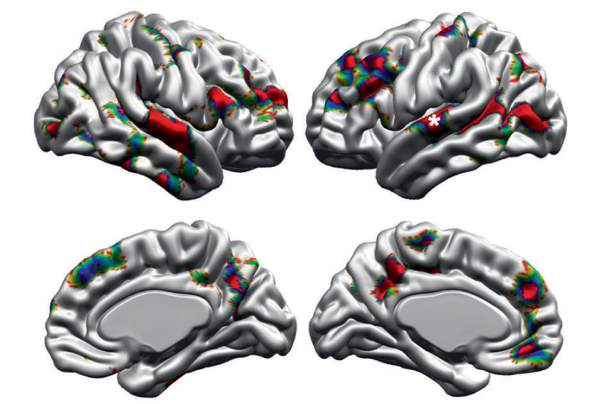 Autisme : différences d'anatomie cérébrale dans l'autisme selon l'â ...